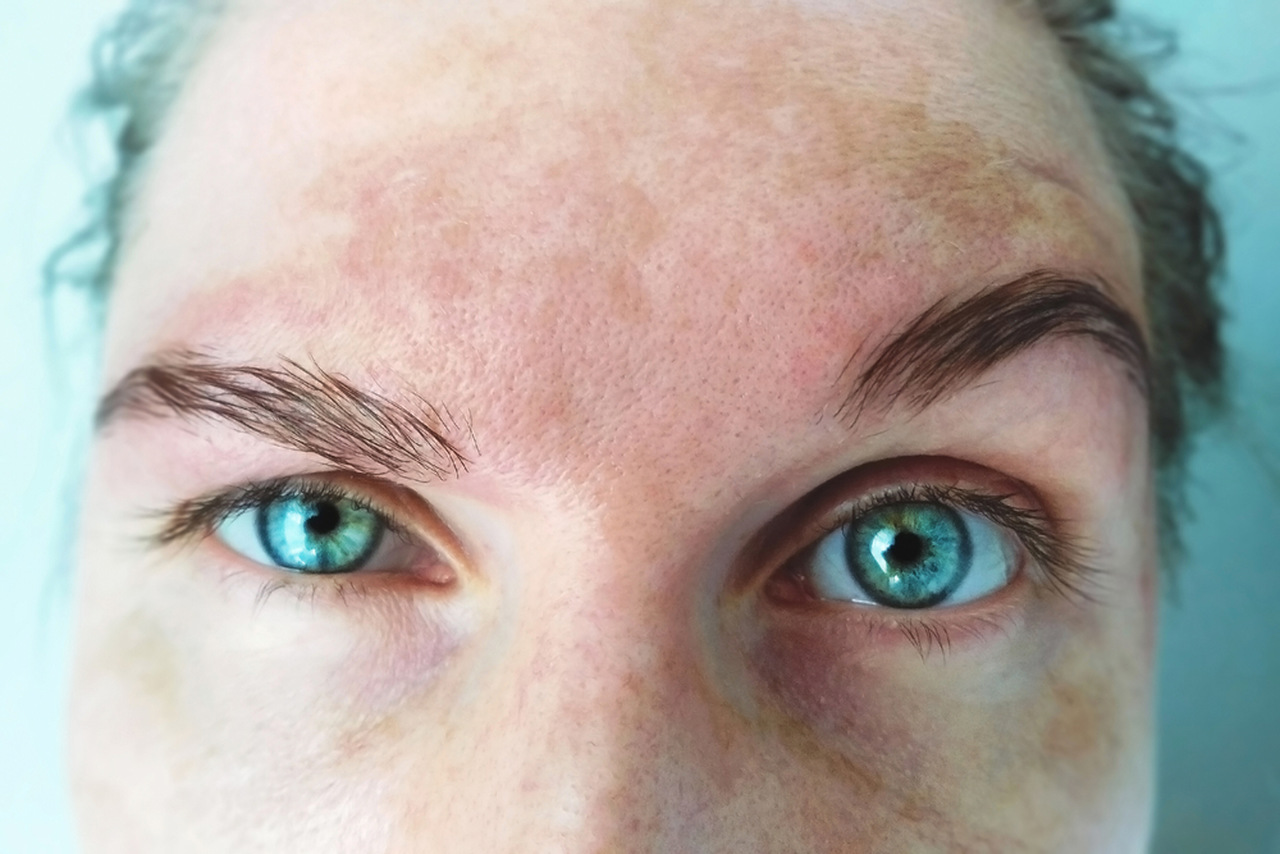 Como identificar o Melasma? Lâmpada de Wood vs Dermatoscopia | Consulfarma